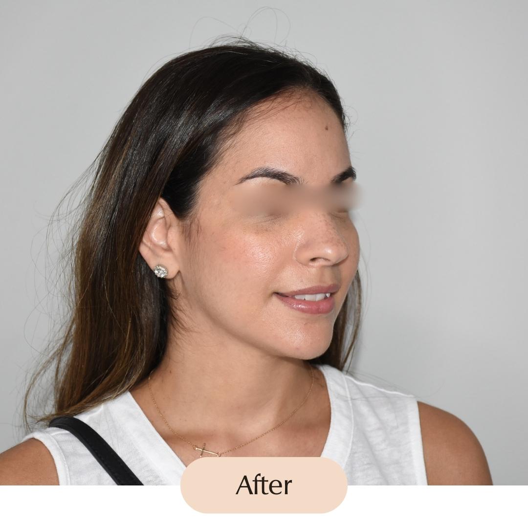 The Essential Acne Program | bergenderm