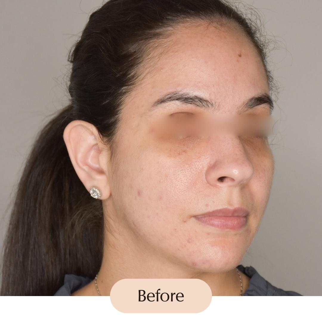 The Essential Acne Program | bergenderm