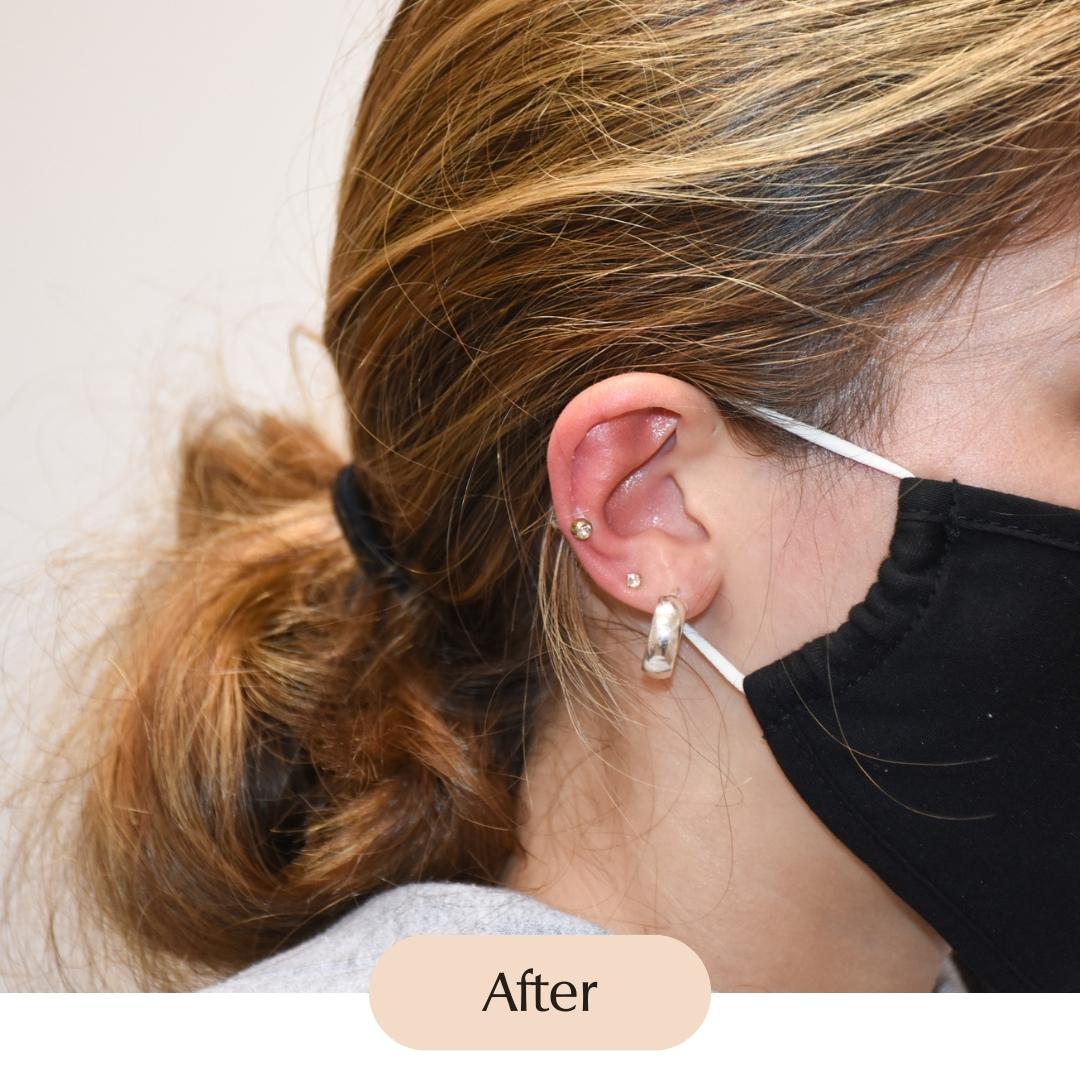 Ear Piercing | bergenderm
