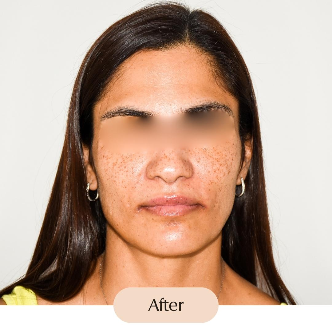 Injectible Fillers | bergenderm